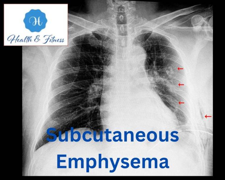 Subcutaneous Emphysema: Causes, Symptoms, And Treatment Options